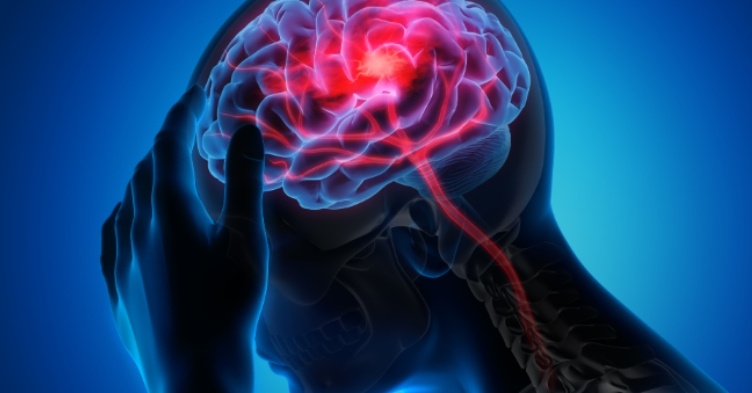 Mythbuster I Don t Need To Go To Hospital For A Mini Stroke 
