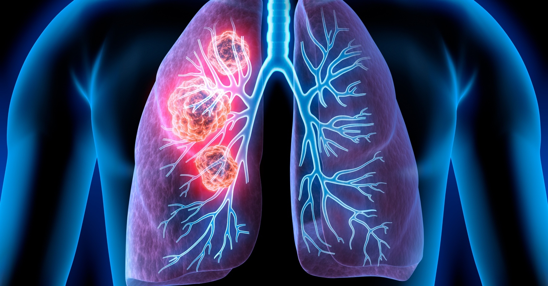 Targeted drugs could be contributing to sharp decline in deaths from ...