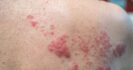 Understanding shingles and the extended vaccination campaign | Nursing ...