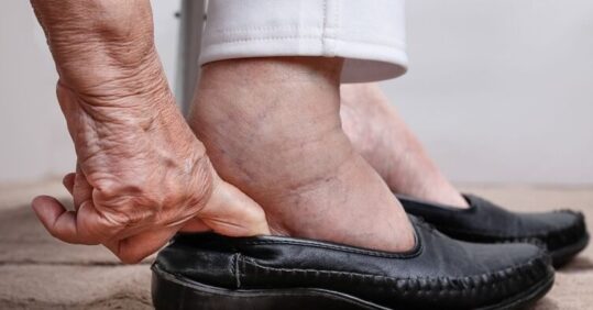 Mythbuster: ‘Her ankles are very swollen – she needs water tablets ...
